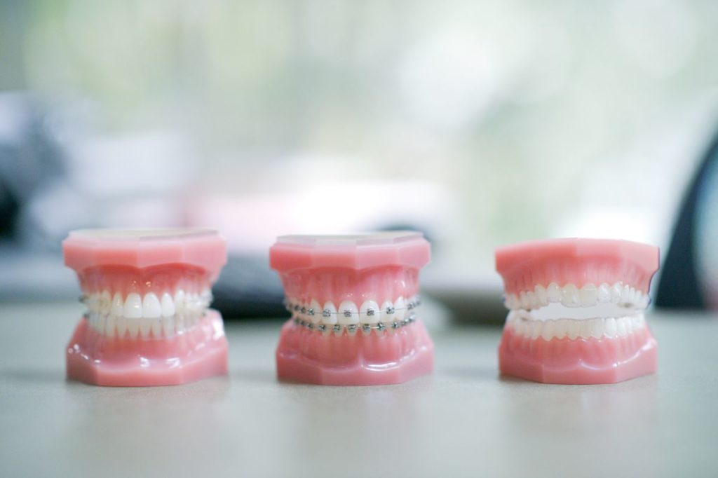 The Benefits of an Aligned Bite | Christian Manley Orthodontics